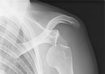 Shoulder Dislocation and Instability | Southeast Georgia Health System