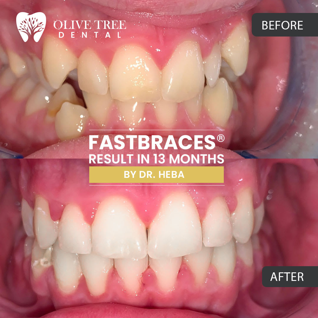 Dental Treatments Before & After - Olive Tree Dental