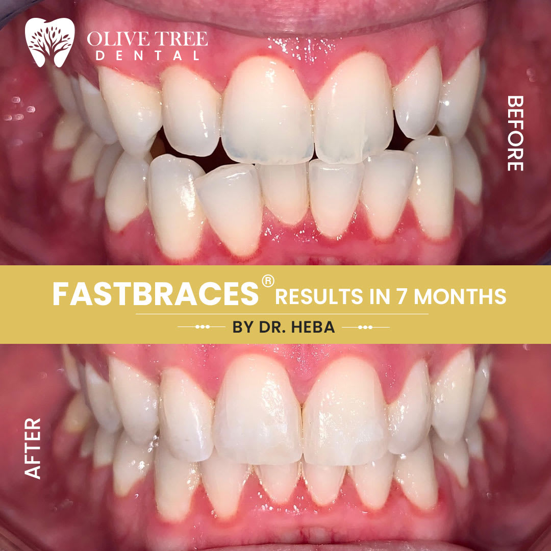 Dental Treatments Before & After - Olive Tree Dental