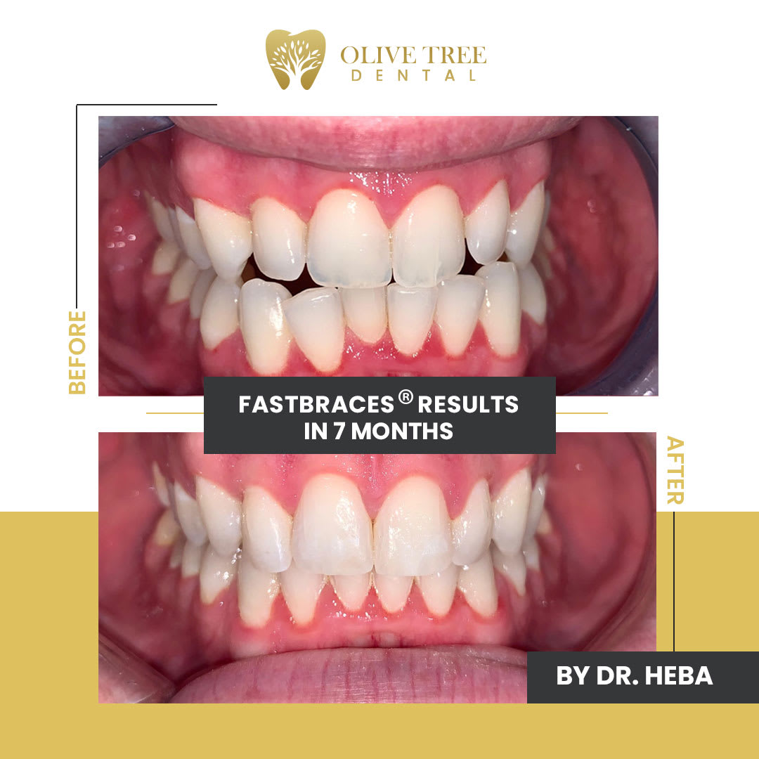Dental Treatments Before & After - Olive Tree Dental