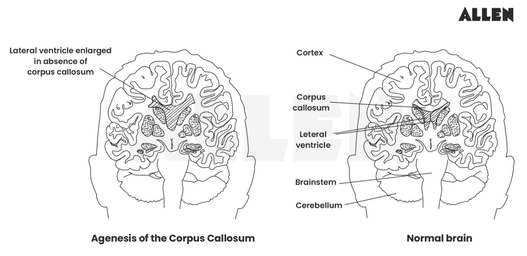 Corpus Callosum: Anatomy, Diagram, Corpus Callosum Function