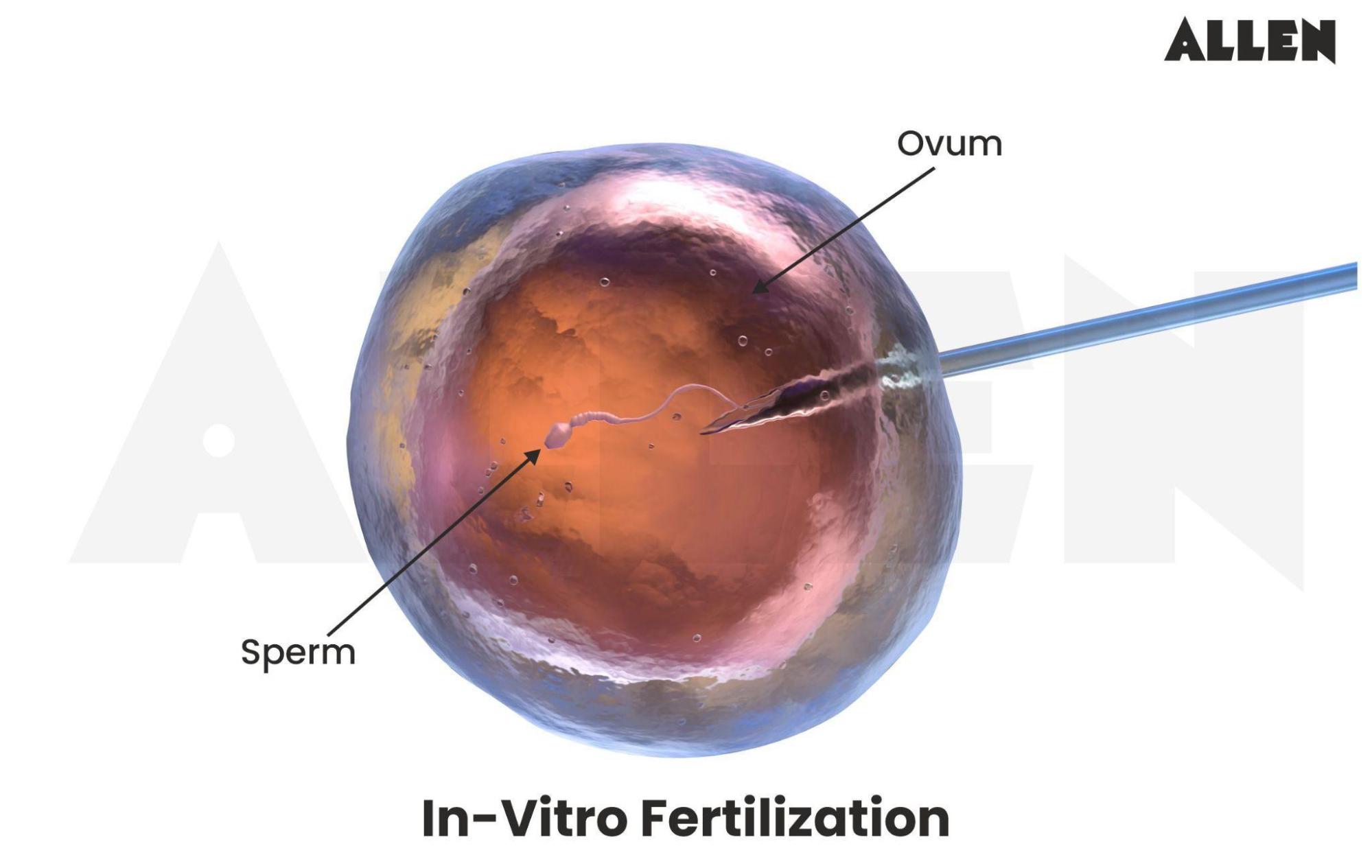 Vitro Fertilization Examples: In Vitro Fertilization – TZXPTR