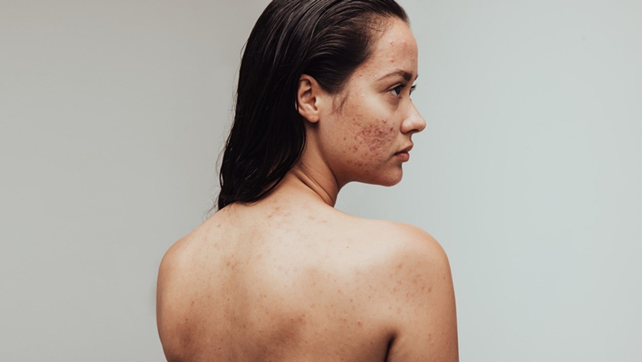 Back Acne or “Bacne”: The Guide to At-Home VS. In-Clinic Treatments ...