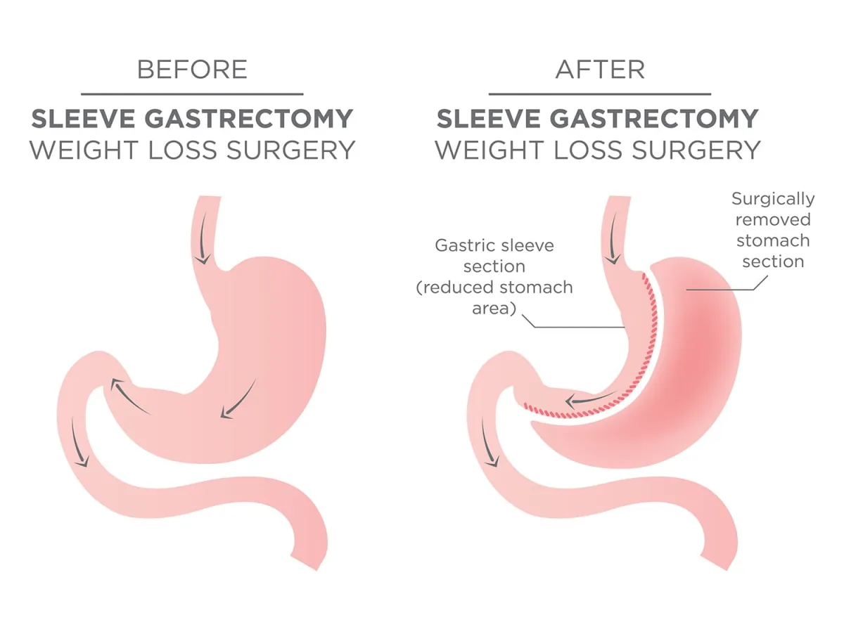 Gastric Sleeve Procedure - How It Works & Who Should Have It | The ...