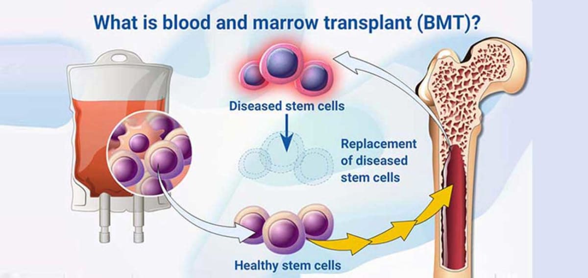 BONE MARROW TRANSPLANT PROCEDURE TYPES RISKS Dr Vishnu Sharma BONE MARROW TRANSPLANT PROCEDURE TYPES RISKS Dr Vishnu Sharma
