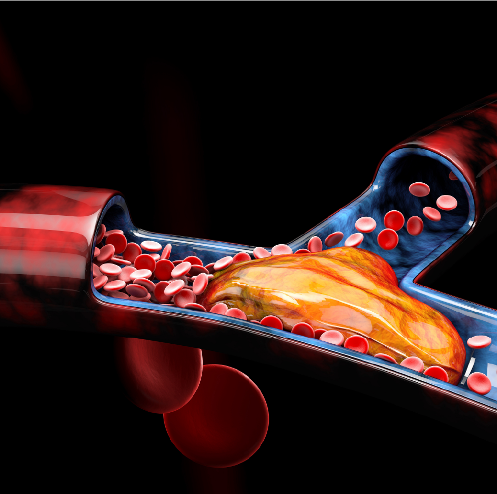 Deep Vein Thrombosis and Pulmonary Embolism, Blood Transfusions