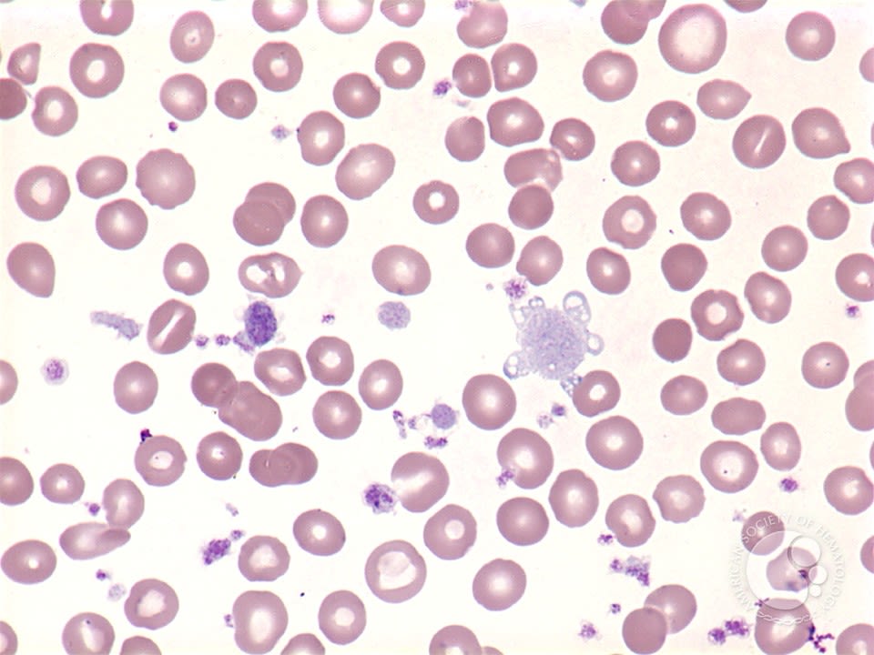 Myeloproliferative Neoplasms (MPNs), Patient Information, Central Coast ...