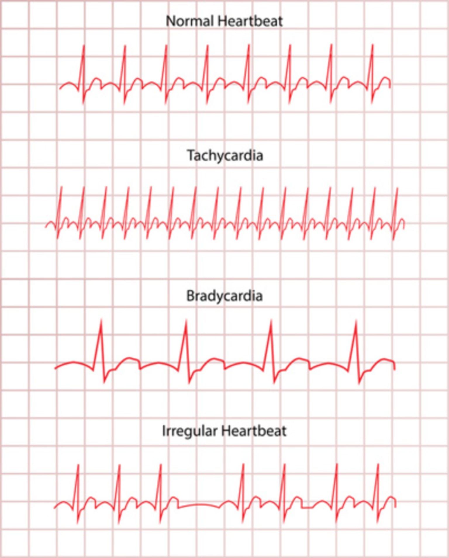 How To Perform Ecg Categorization And Detect Arrhythmia Knime