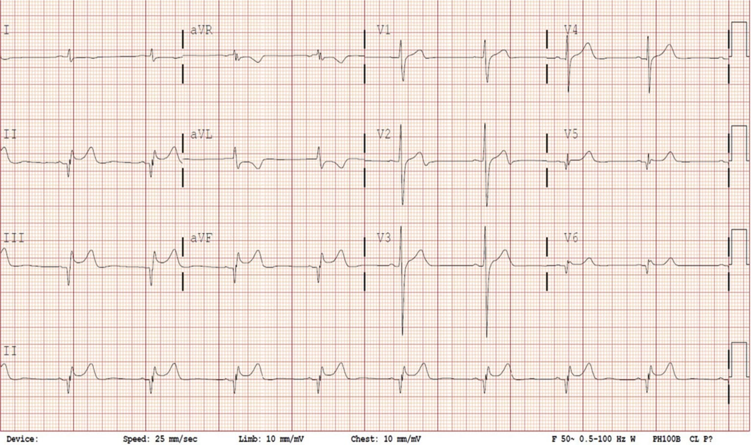 Learn How to Classify ECG Signals with DL in KNIME | KNIME