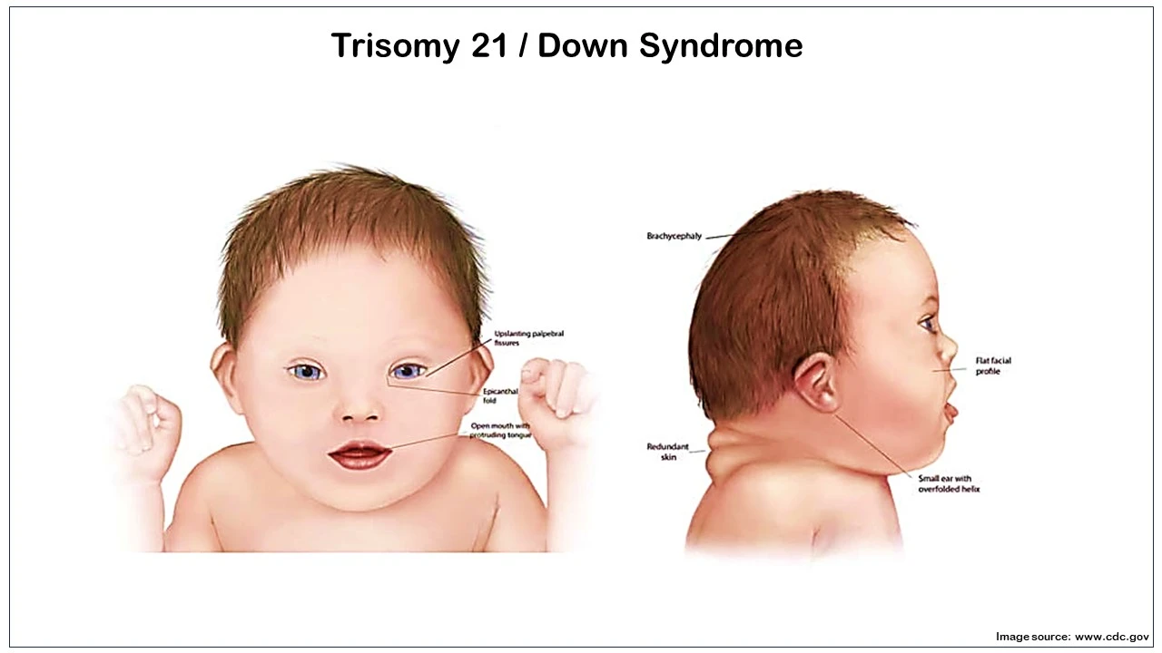 Down Syndrome/Trisomy 21- Explained