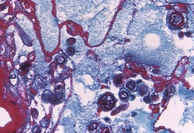 Varicella | National Geographic Society