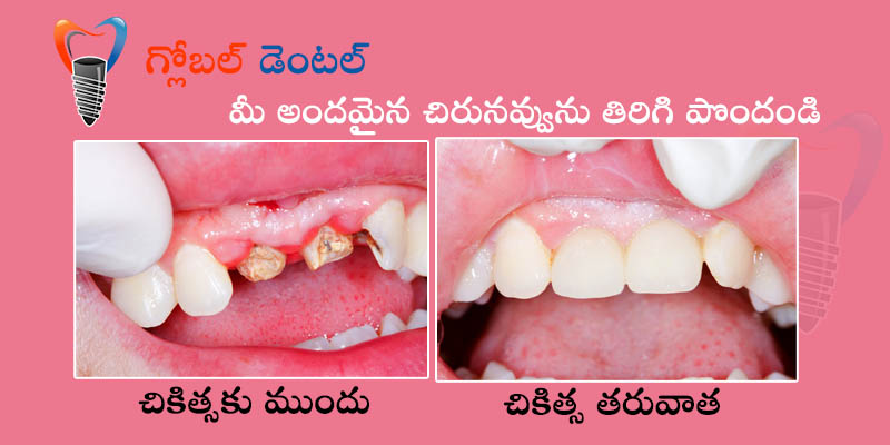 Best Dental Clinic & Implant Center in Tirupati | New Global Dental
