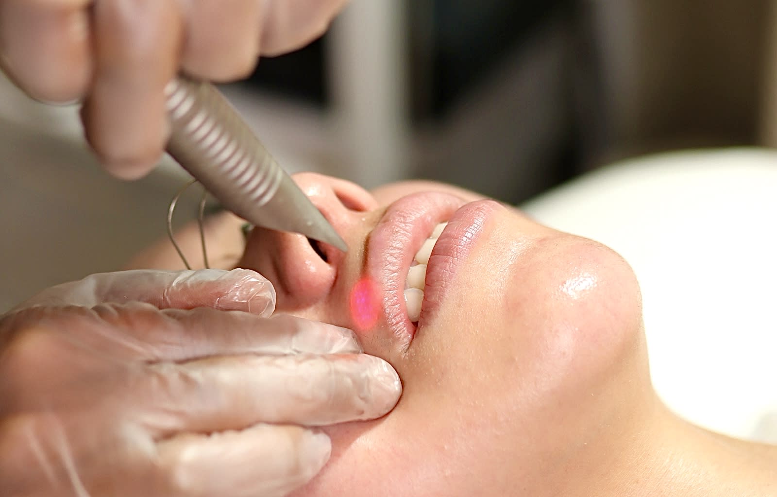 Laser Lip Remodelling l Vancouver Medi Spa