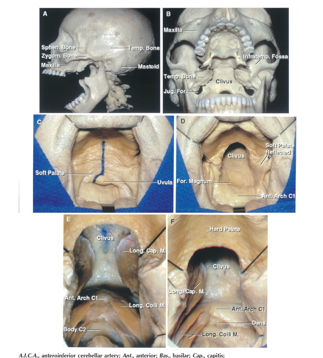 Transoral, Transpalatal, and Transmaxillary Approaches to the Clivus ...