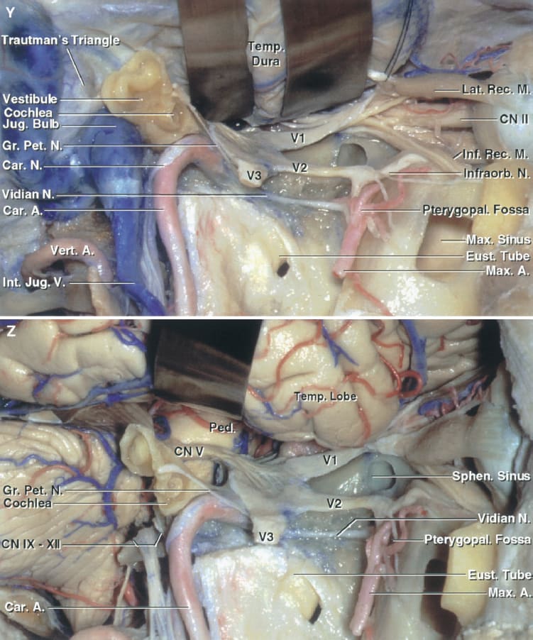 Anatomic Basis of the Postauricular Transtemporal Approach ...