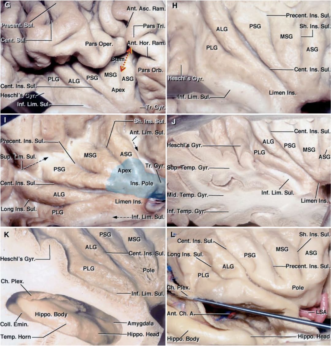 Stepwise Dissection of Right Cerebral Hemisphere | Neuroanatomy | The ...