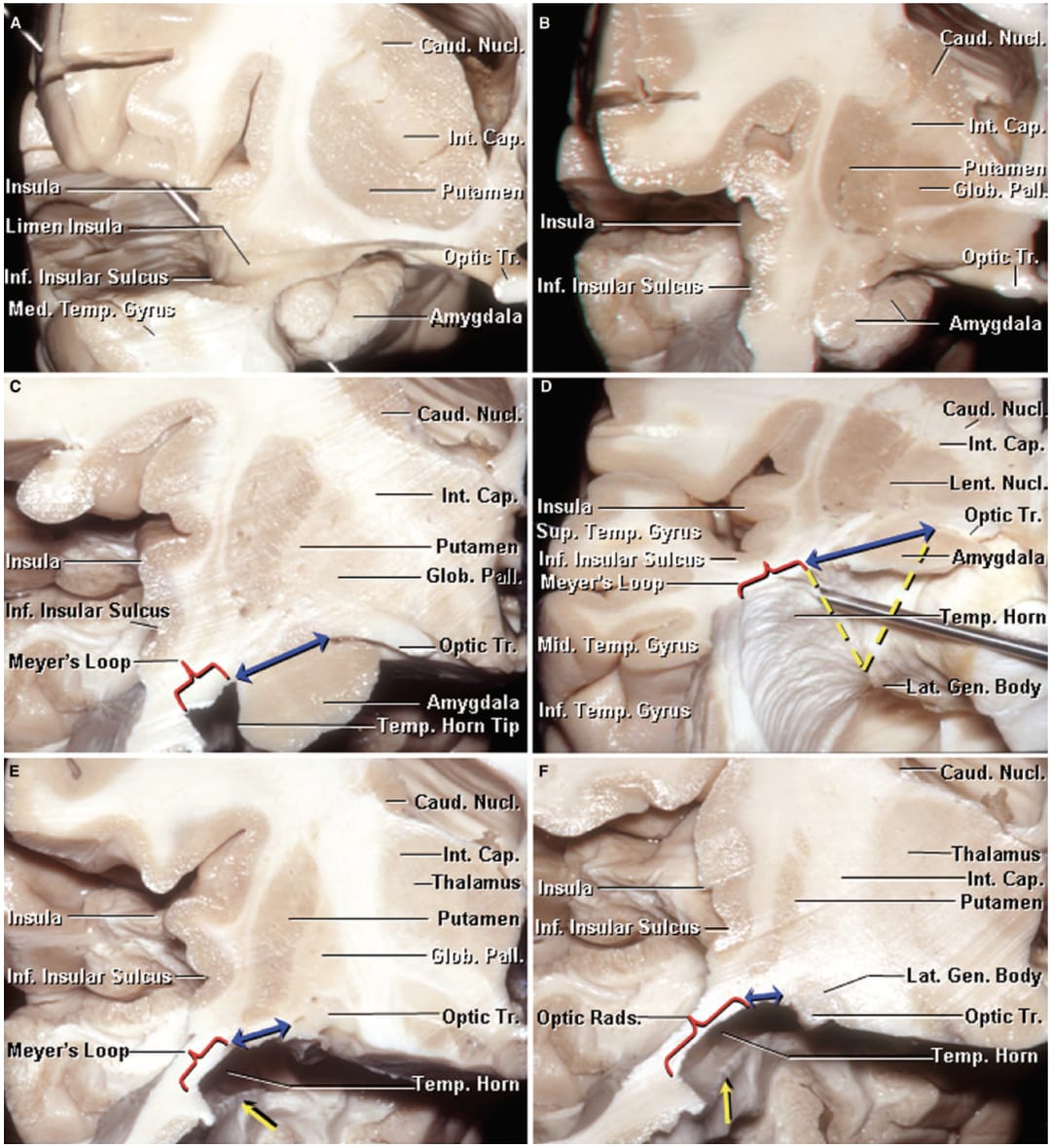 Coronal Sections of Deep Nuclei | Neuroanatomy | The Neurosurgical Atlas