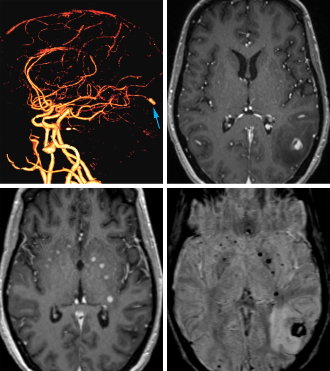 Imaging Evaluation of SAH and Aneurysm | Cohen Collection | Volumes ...