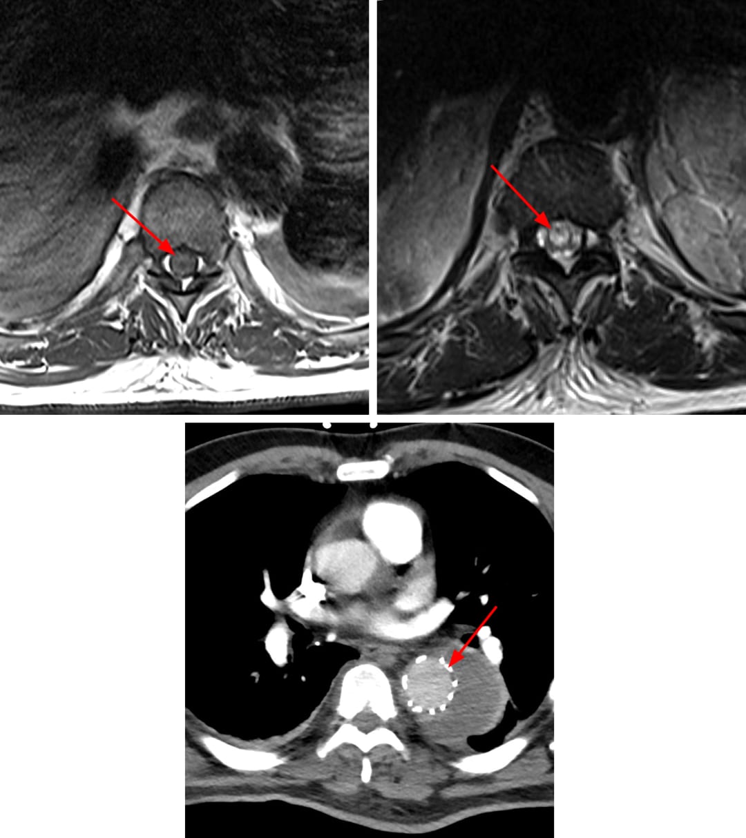 Spinal Cord Infarct | Cohen Collection | Volumes | The Neurosurgical Atlas