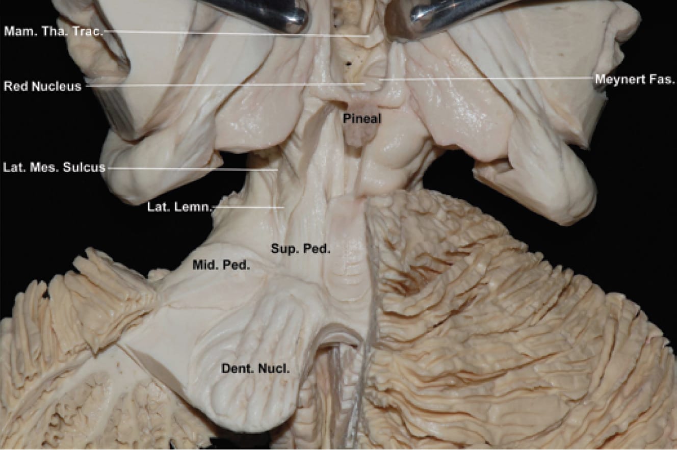 Posterior View of the Midbrain and Tentorial Surface of the Right ...
