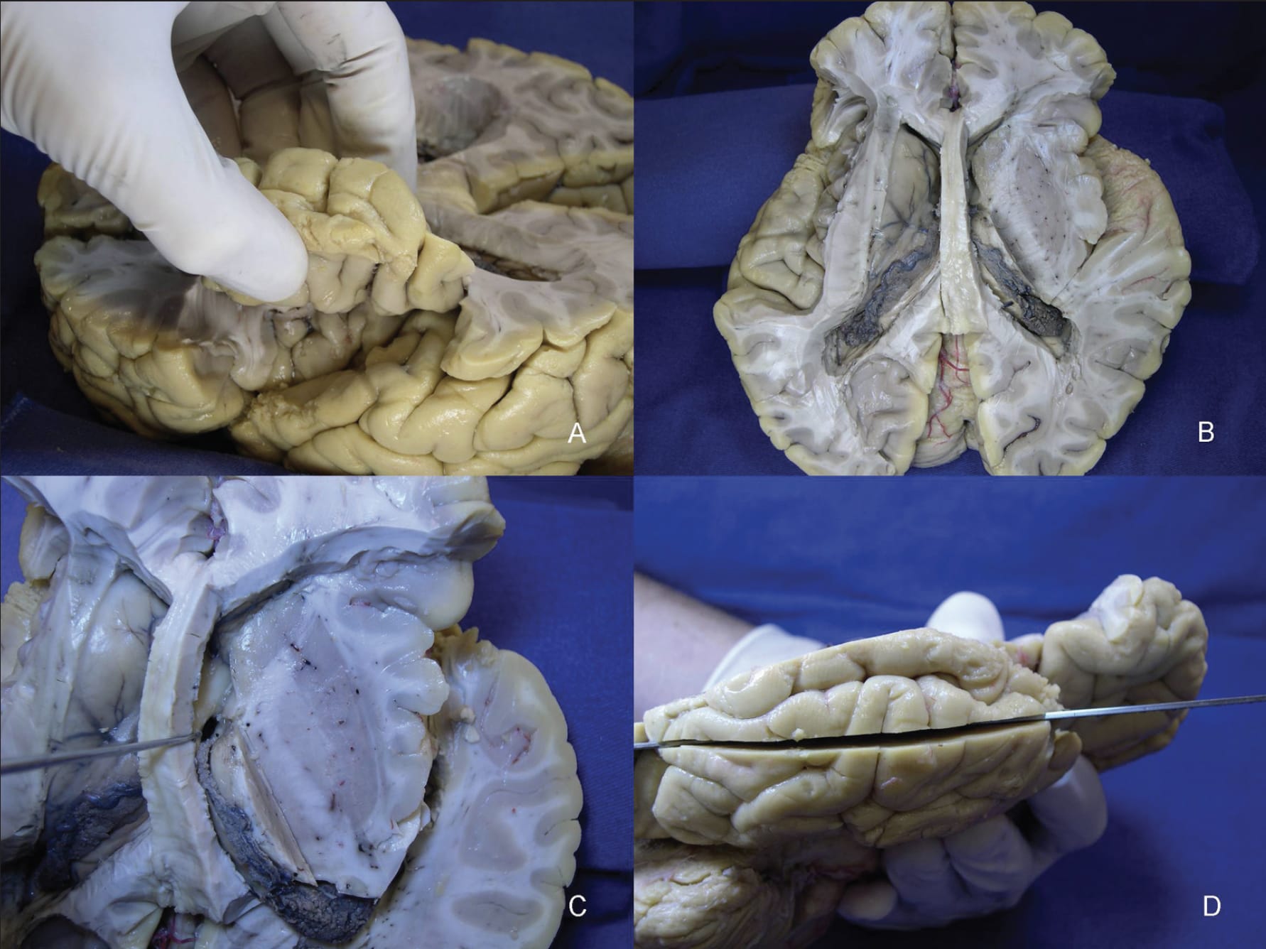 Fixed Brain Dissection | Neuroanatomy | The Neurosurgical Atlas