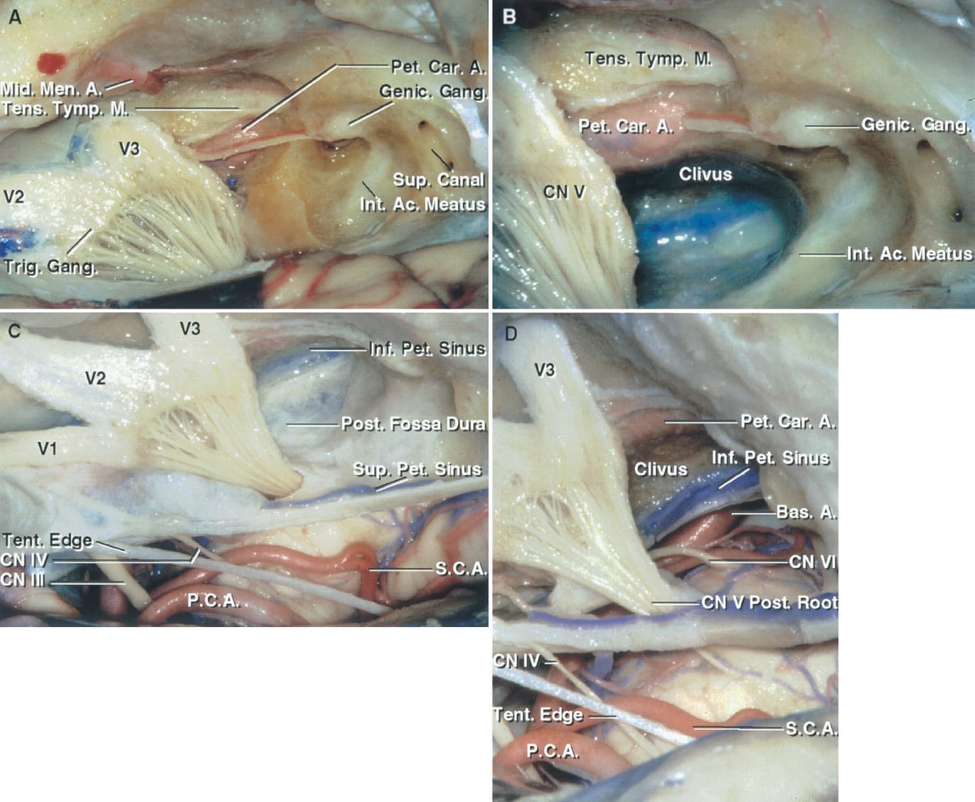 Anterior Petrosectomy and Extended Middle Fossa Approach | Neuroanatomy ...