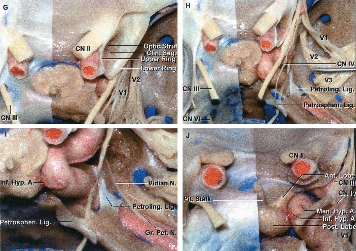 Superior View of the Sellar Region | Neuroanatomy | The Neurosurgical Atlas