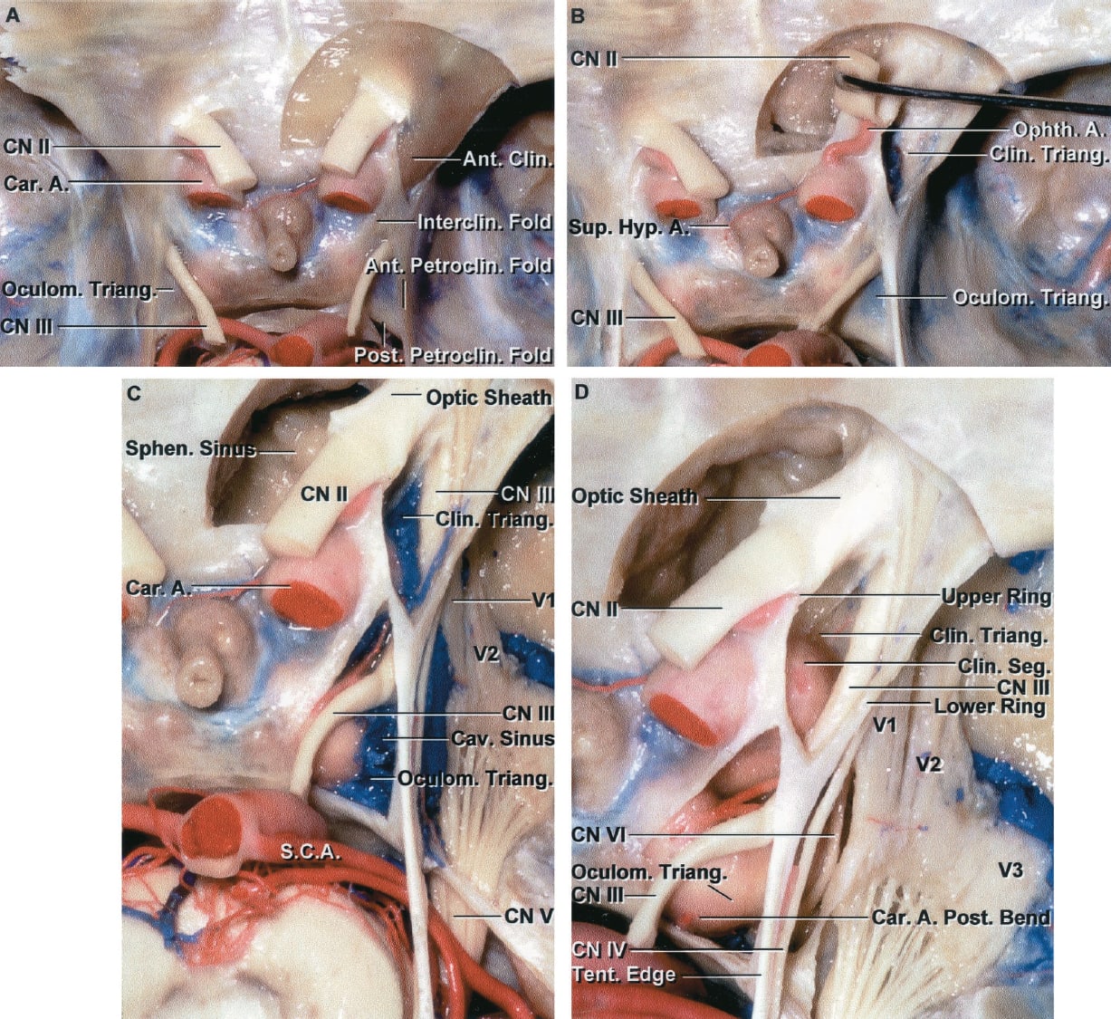 Posterior Superior View of the Jugular Foramen | Neuroanatomy | The ...