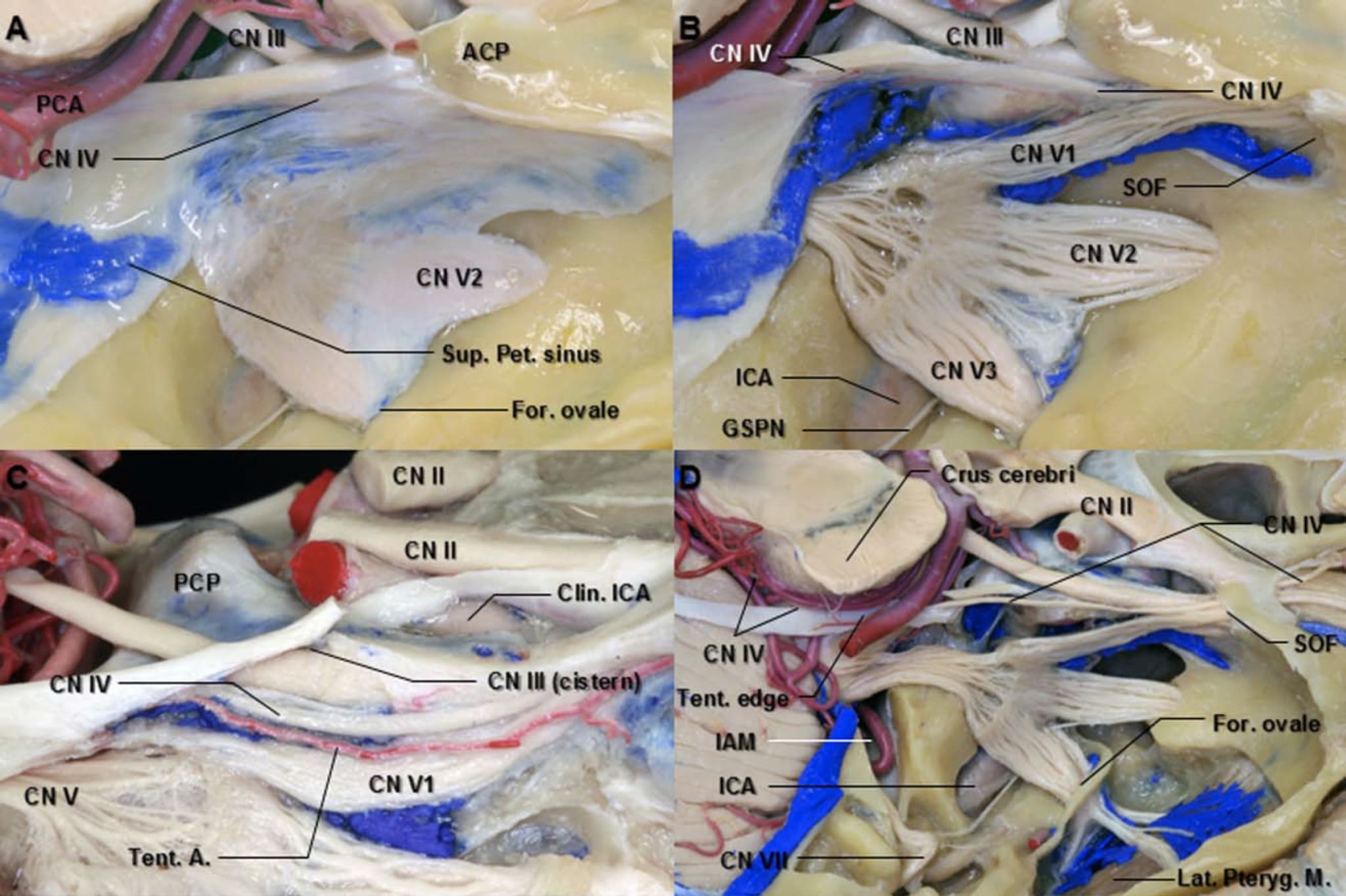 The Cavernous Sinus and Meckel’s Cave | Neuroanatomy | The ...