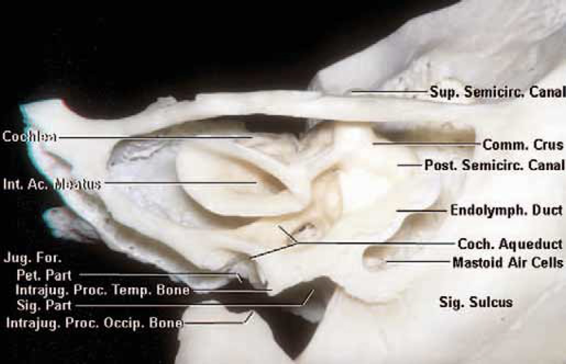 The Internal Acoustic Meatus, Semicircular Canals, and Cochlea ...
