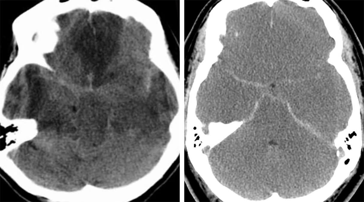 Imaging Evaluation of SAH and Aneurysm | Cohen Collection | Volumes ...