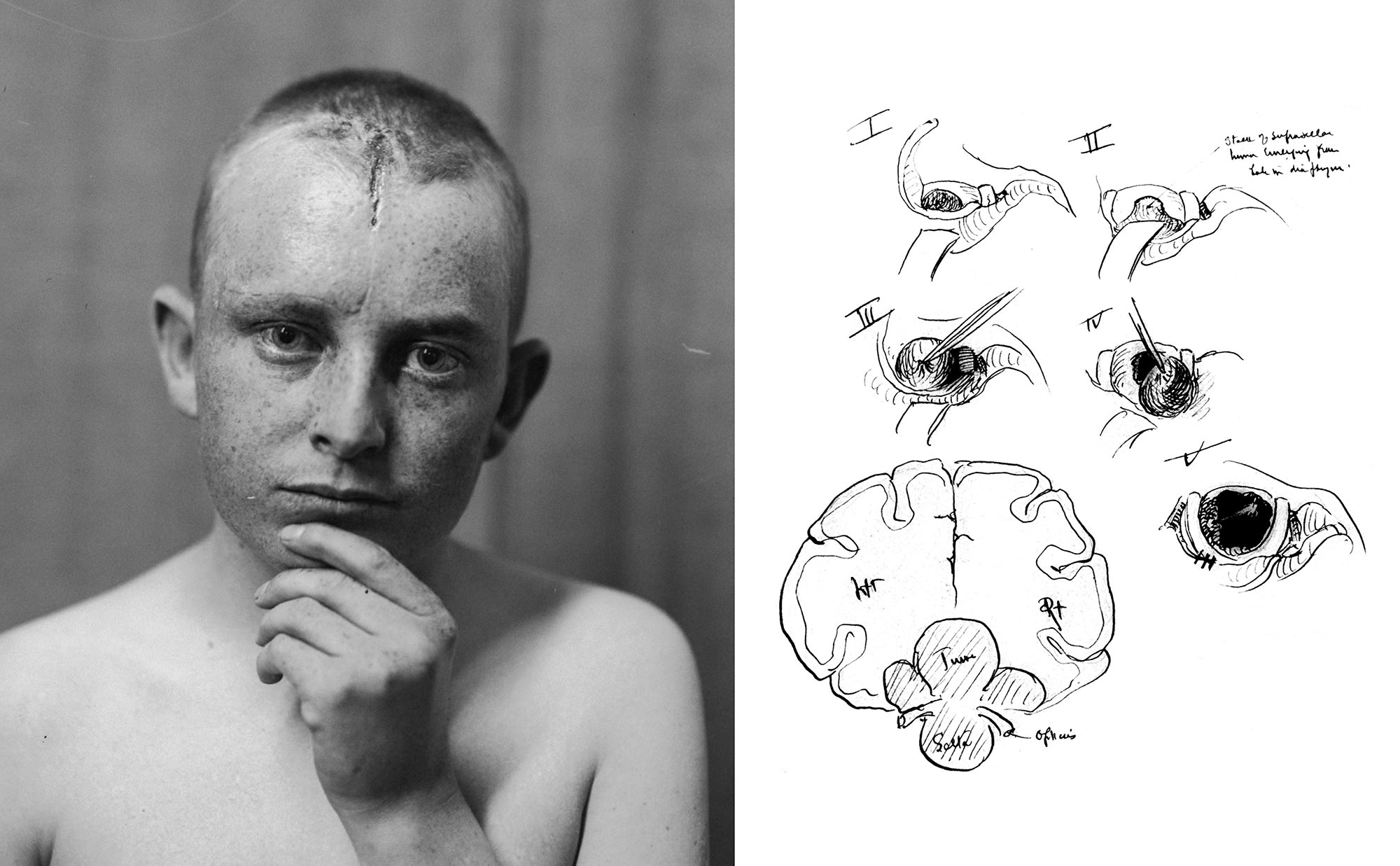 Microscope-Guided Endonasal Transsphenoidal Approach | Cohen Collection ...