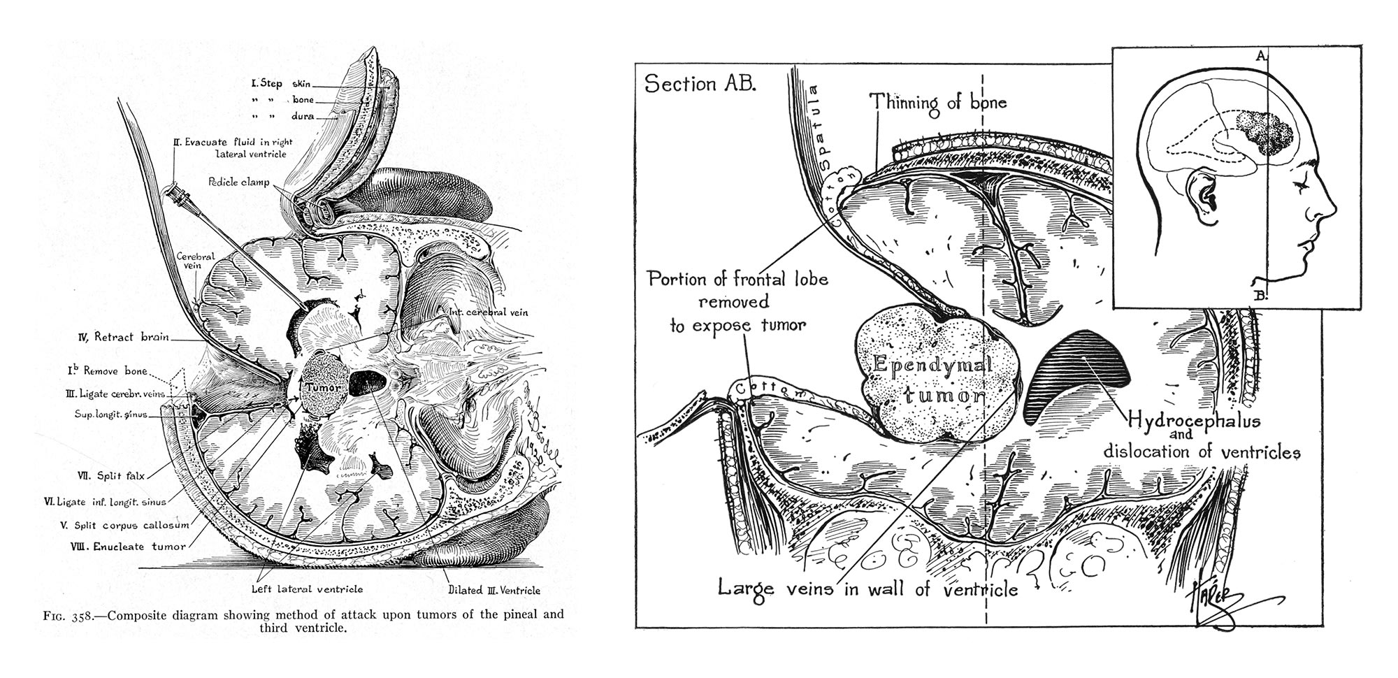 Lateral Ventricular Tumors | Cohen Collection | Volumes | The ...