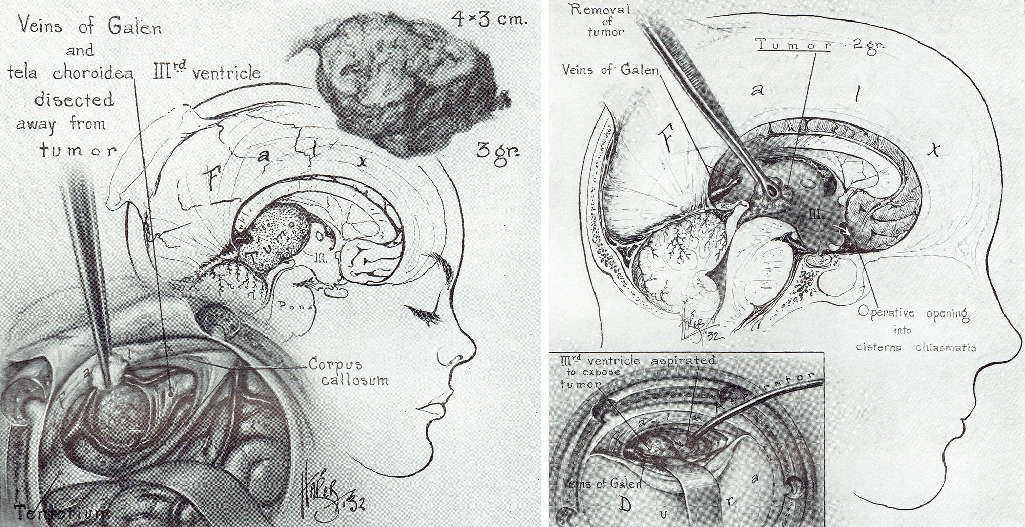 Posterior Interhemispheric Transcallosal Intervenous/Paravenous Variant ...