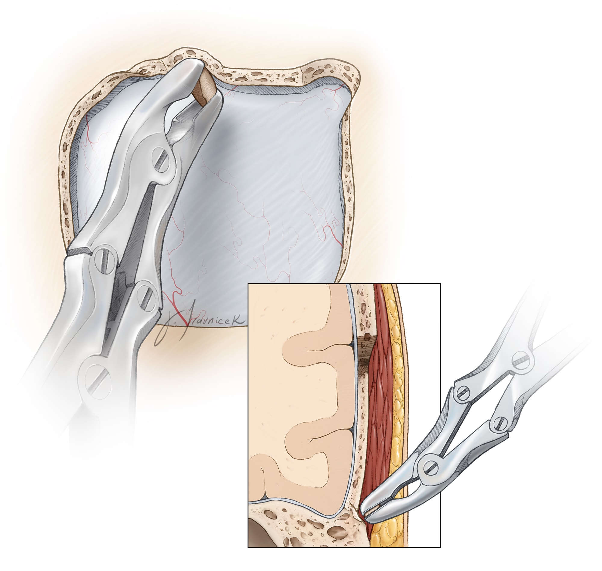 Anterior Petrosectomy | Cohen Collection | Volumes | The Neurosurgical ...