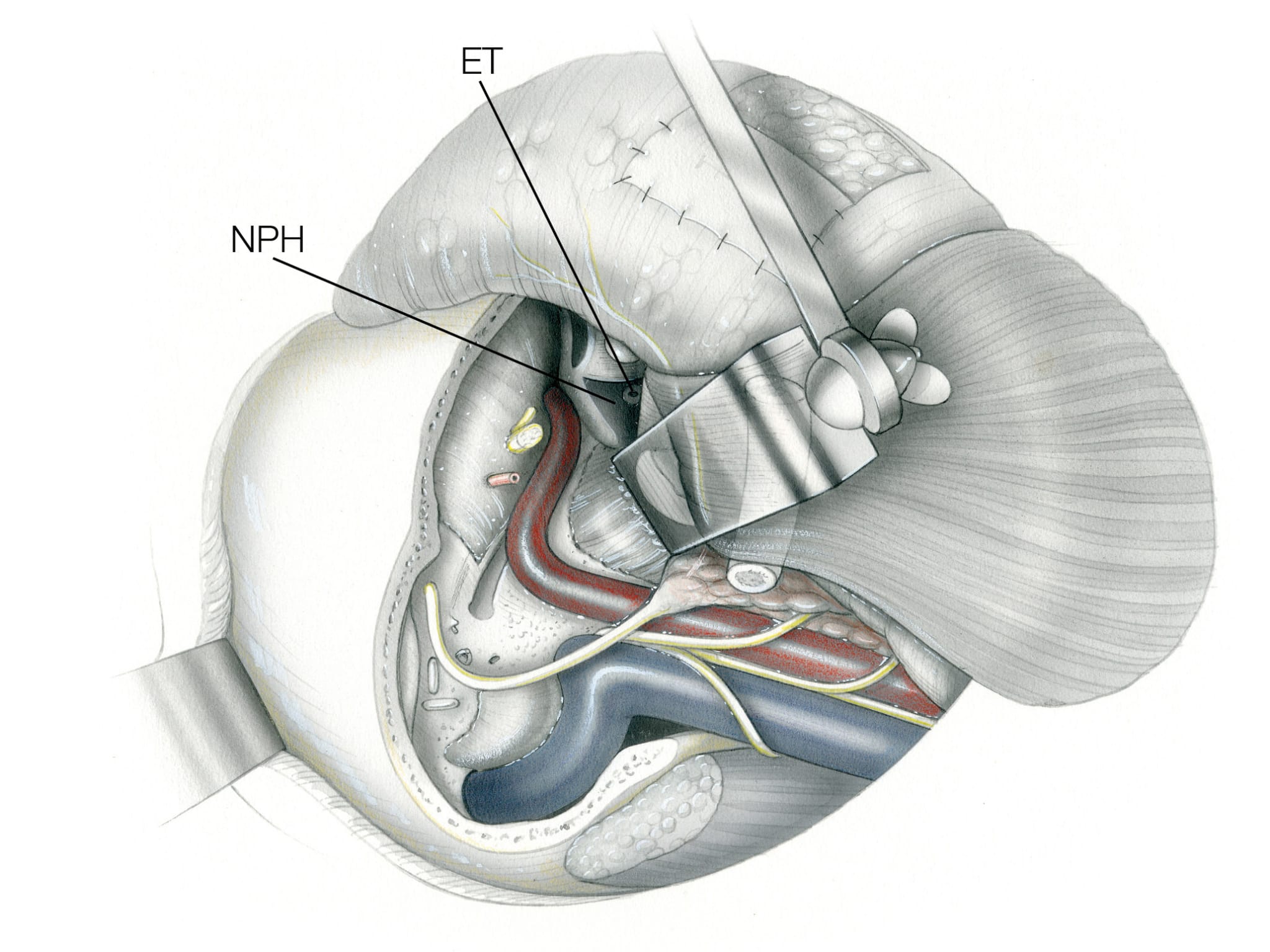 Infratemporal Fossa Approaches | Jackler Collection | Volumes | The ...