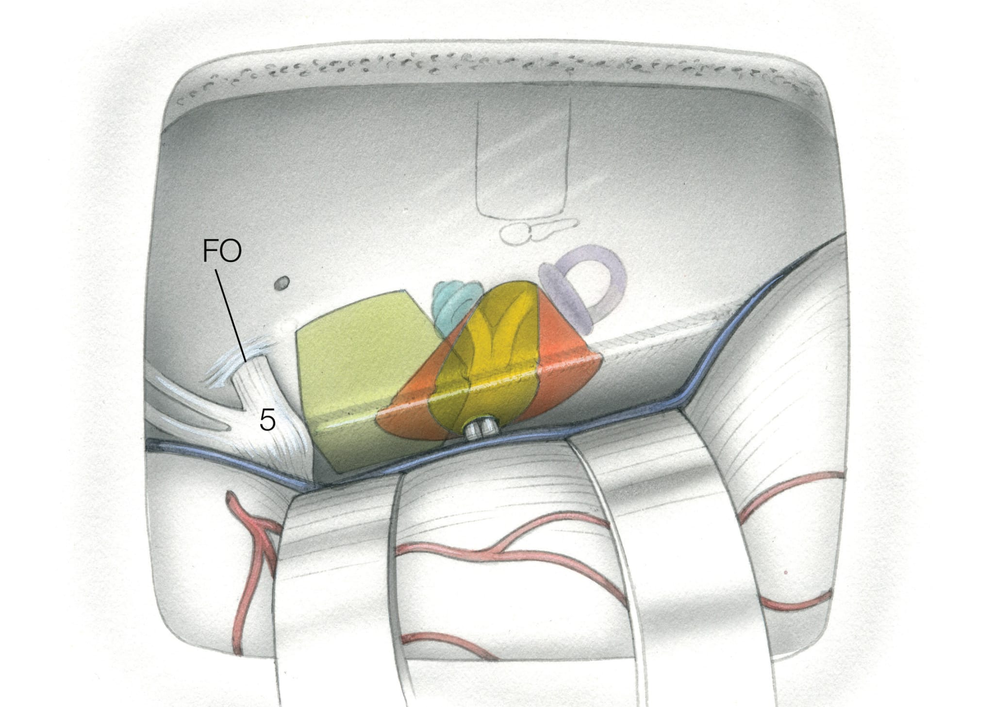 Middle Fossa Approach to Meckel's Cave | Jackler Collection | Volumes ...