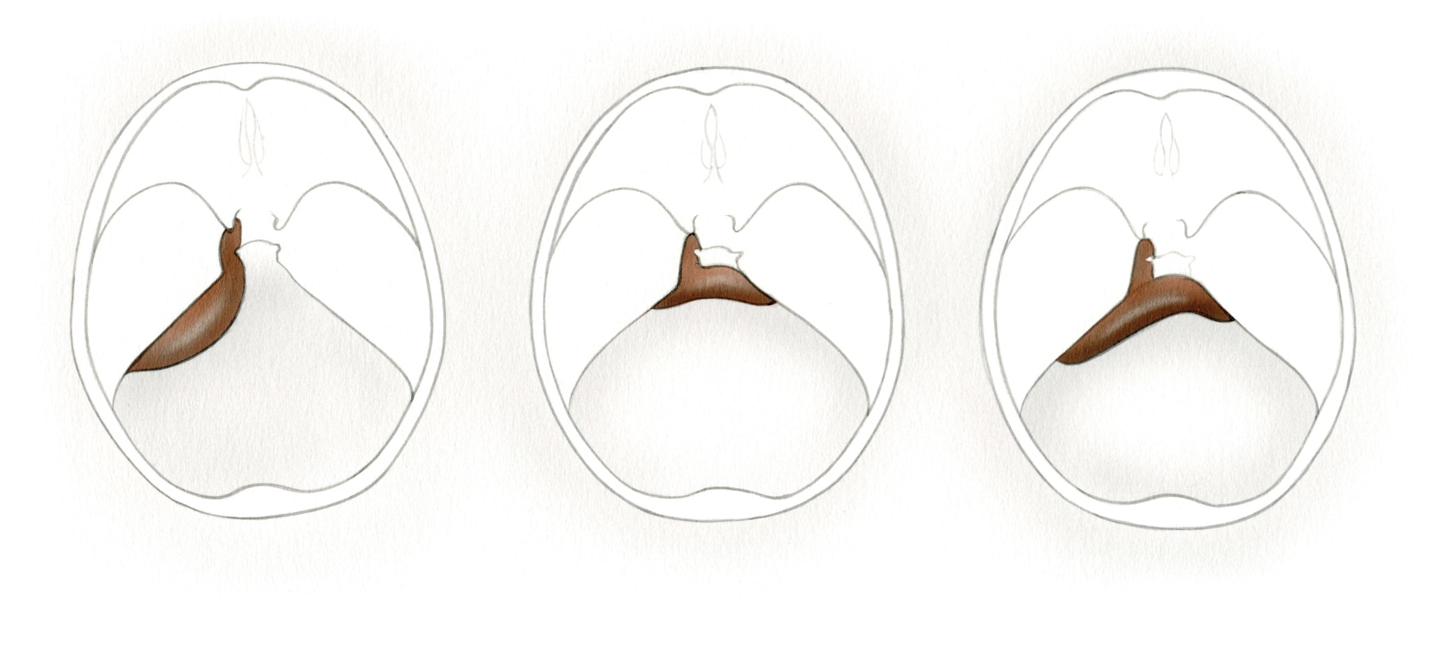 Posterior Fossa Approach to Meckel's Cave | Jackler Collection ...