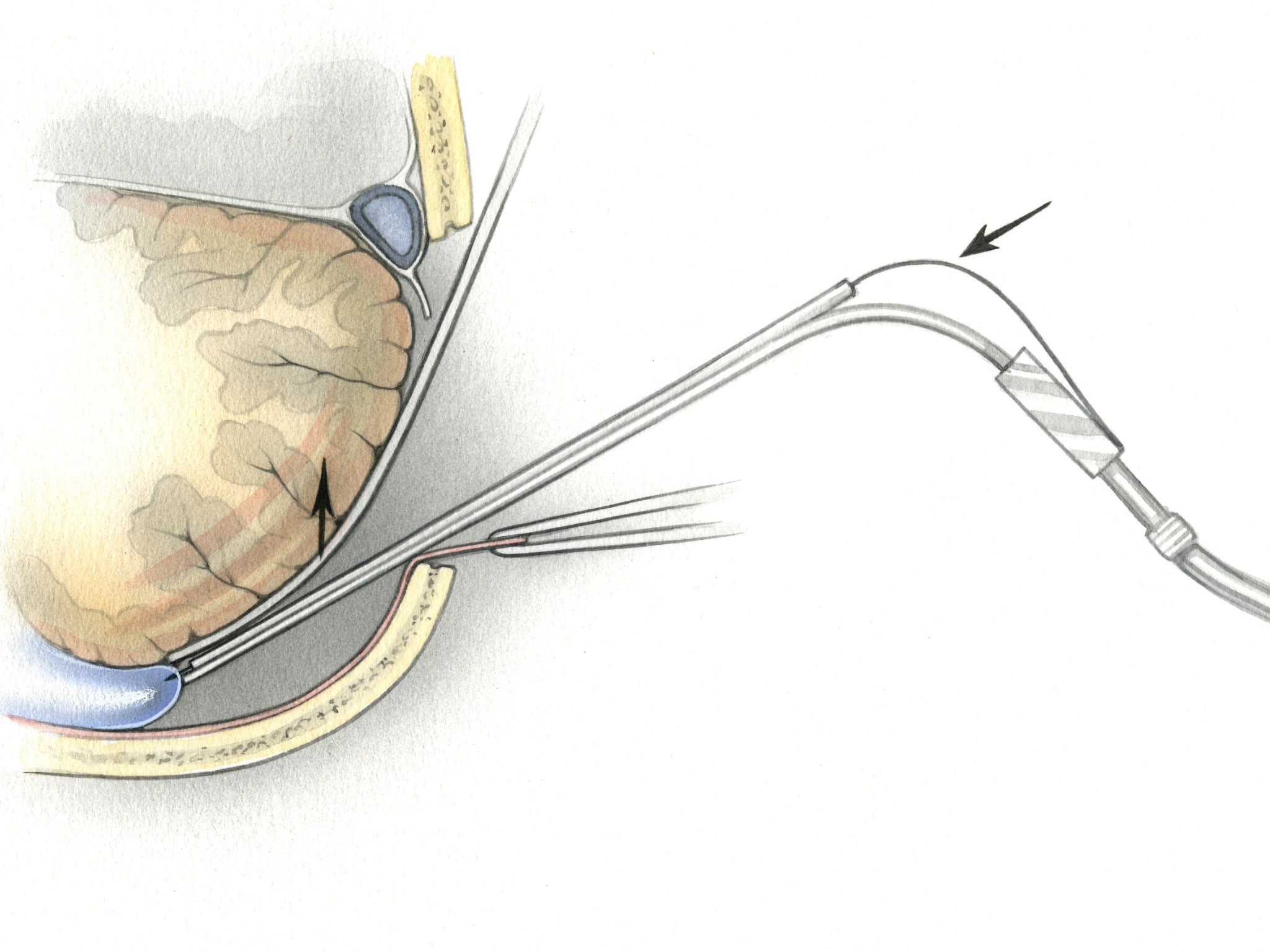 Retrosigmoid Approach to the Internal Auditory Canal and ...