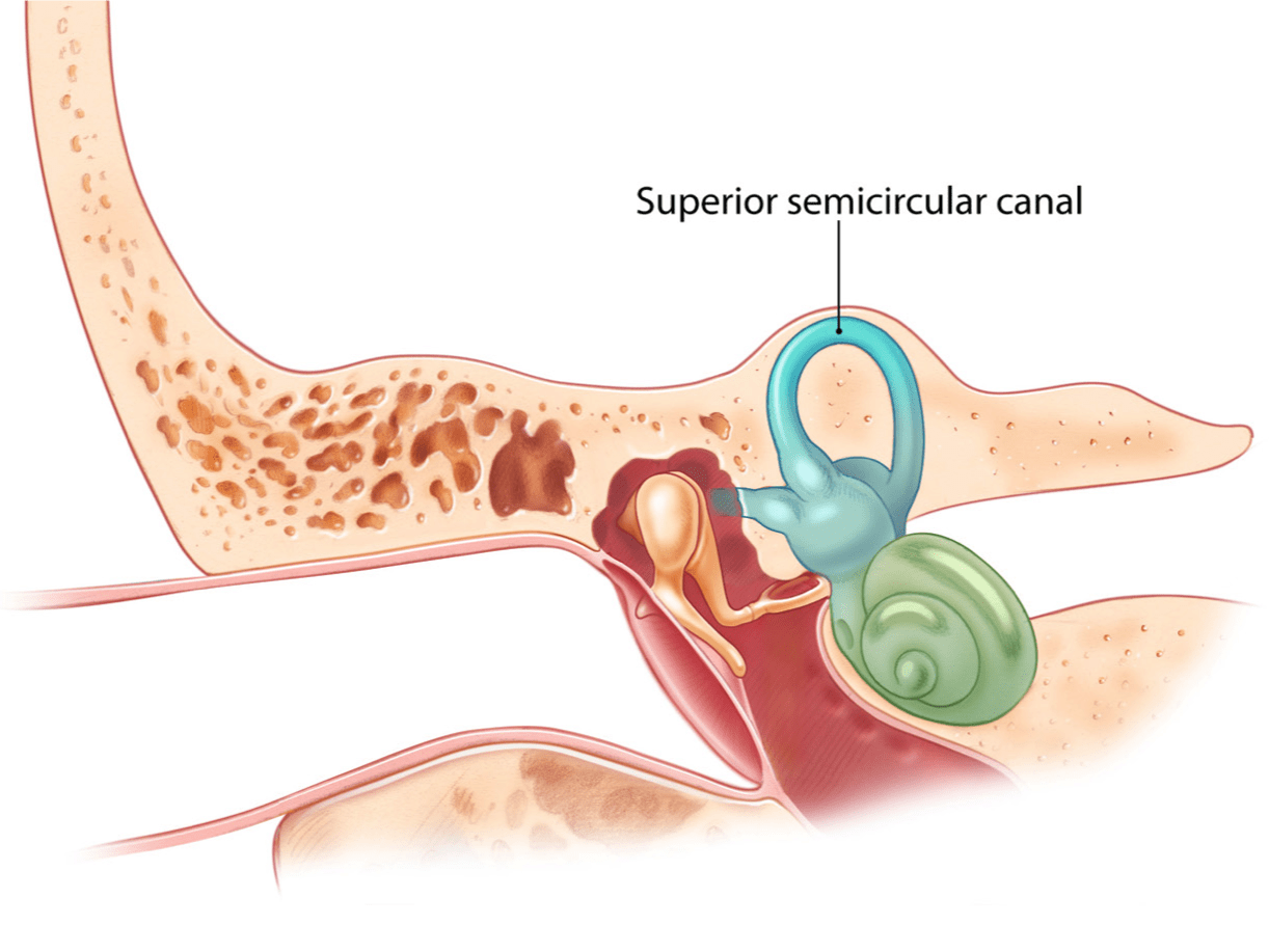 Semicircular Canal Dehiscence | Jackler Collection | Volumes | The ...