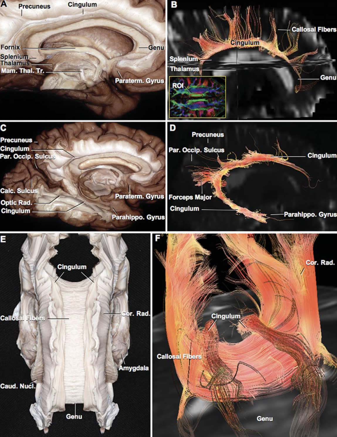 Cingulum | Neuroanatomy | The Neurosurgical Atlas