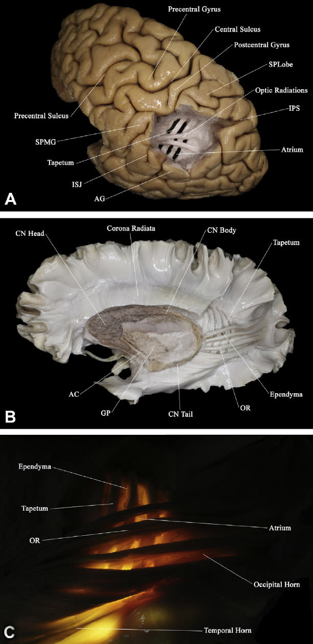 Lateral View of the Brain With a Centered Window at the Level of the ...