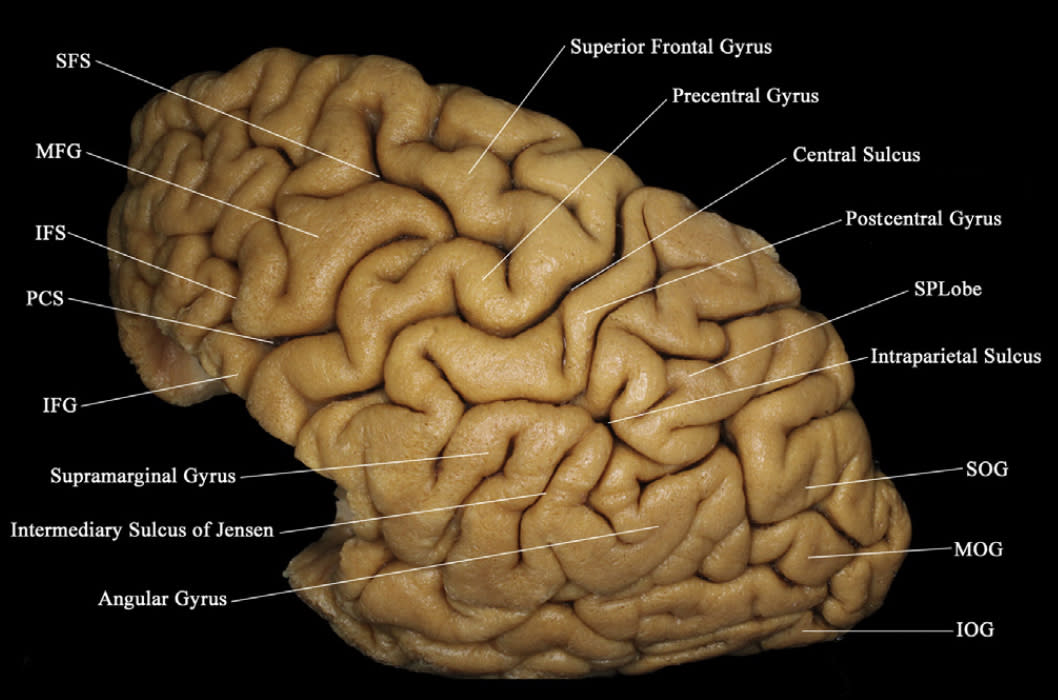 Lateral View of the Lateral Cerebral Surface Showing the Sulci and Gyri ...