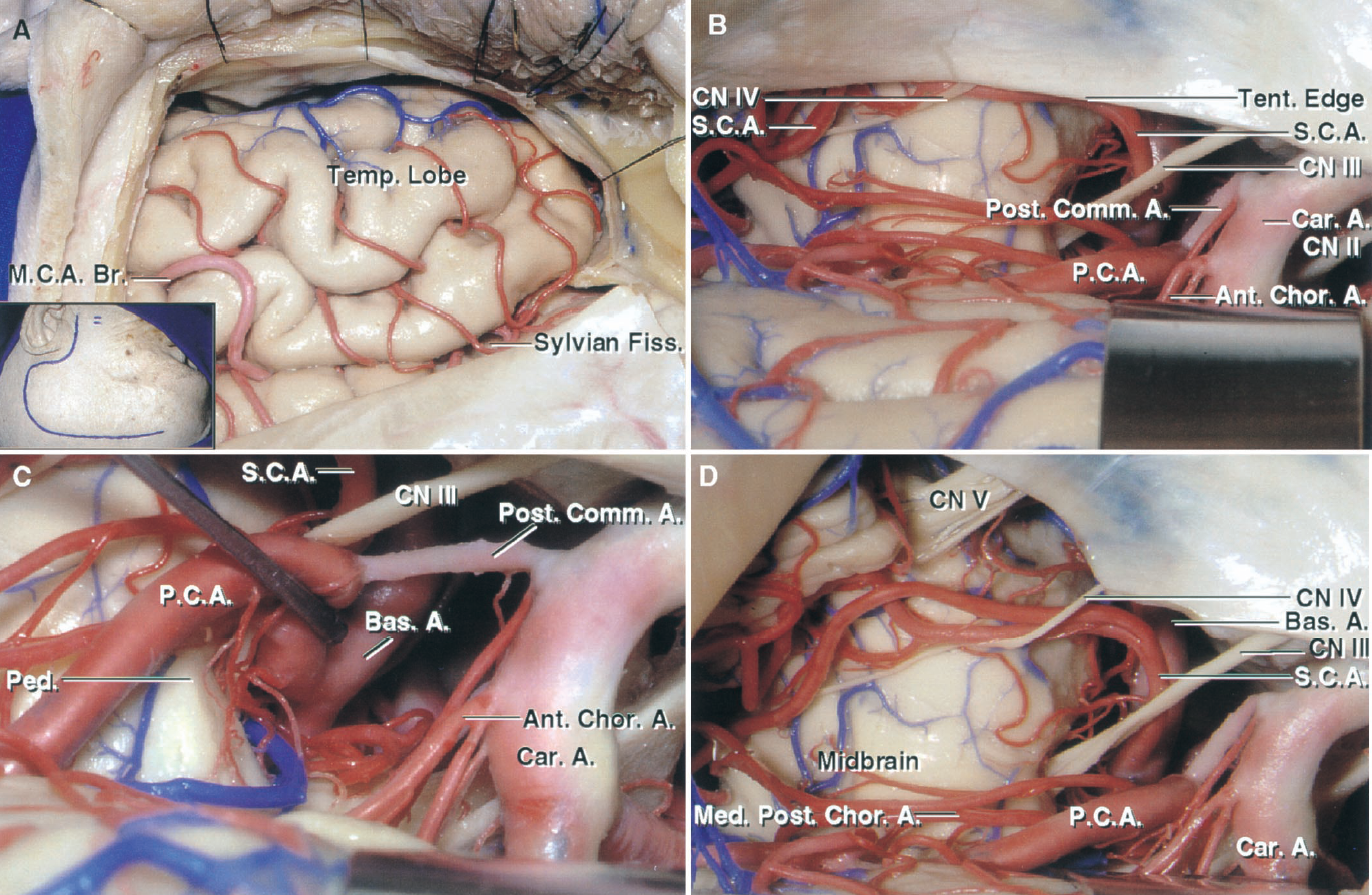 Anterior and Middle Subtemporal Exposure of the Anterior and Adjacent ...