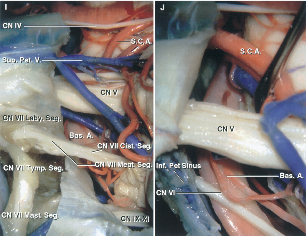 Comparison of the Retrosigmoid Approach and the Minimal Mastoidectomy ...
