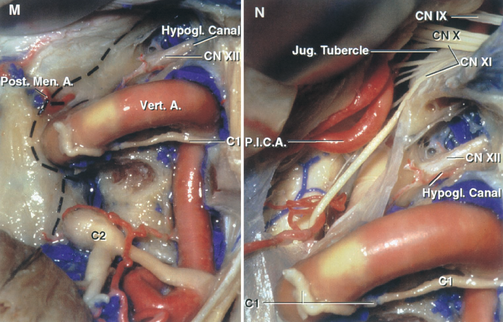 Combined Presigmoid and Far-Lateral Approach | Neuroanatomy | The ...
