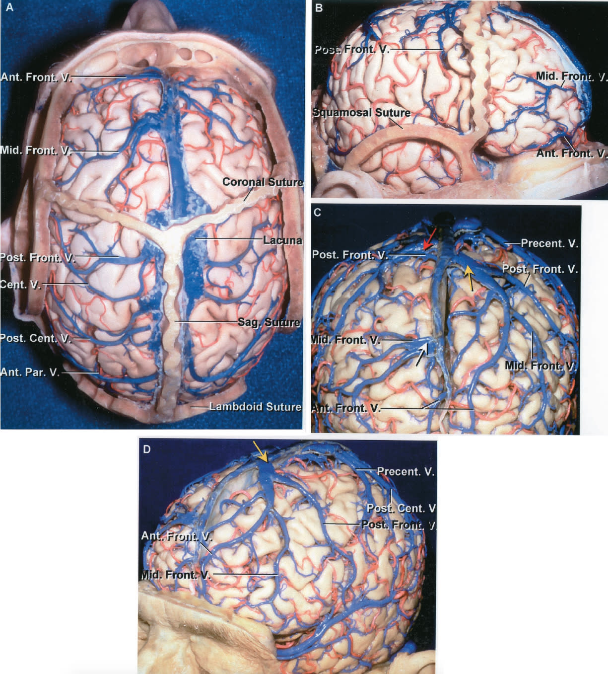 Cerebrum with the Coronal and Sagittal Sutures Preserved | Neuroanatomy ...