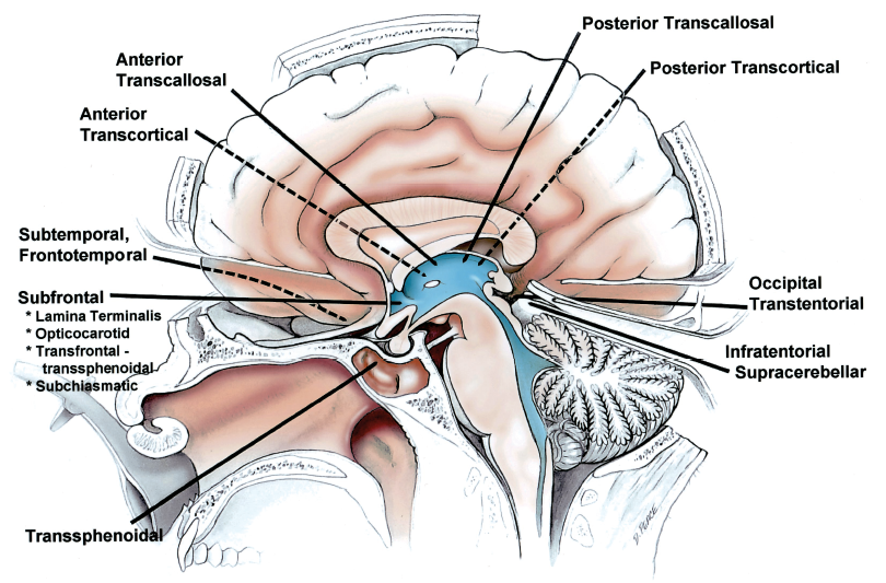 posterior ventricle