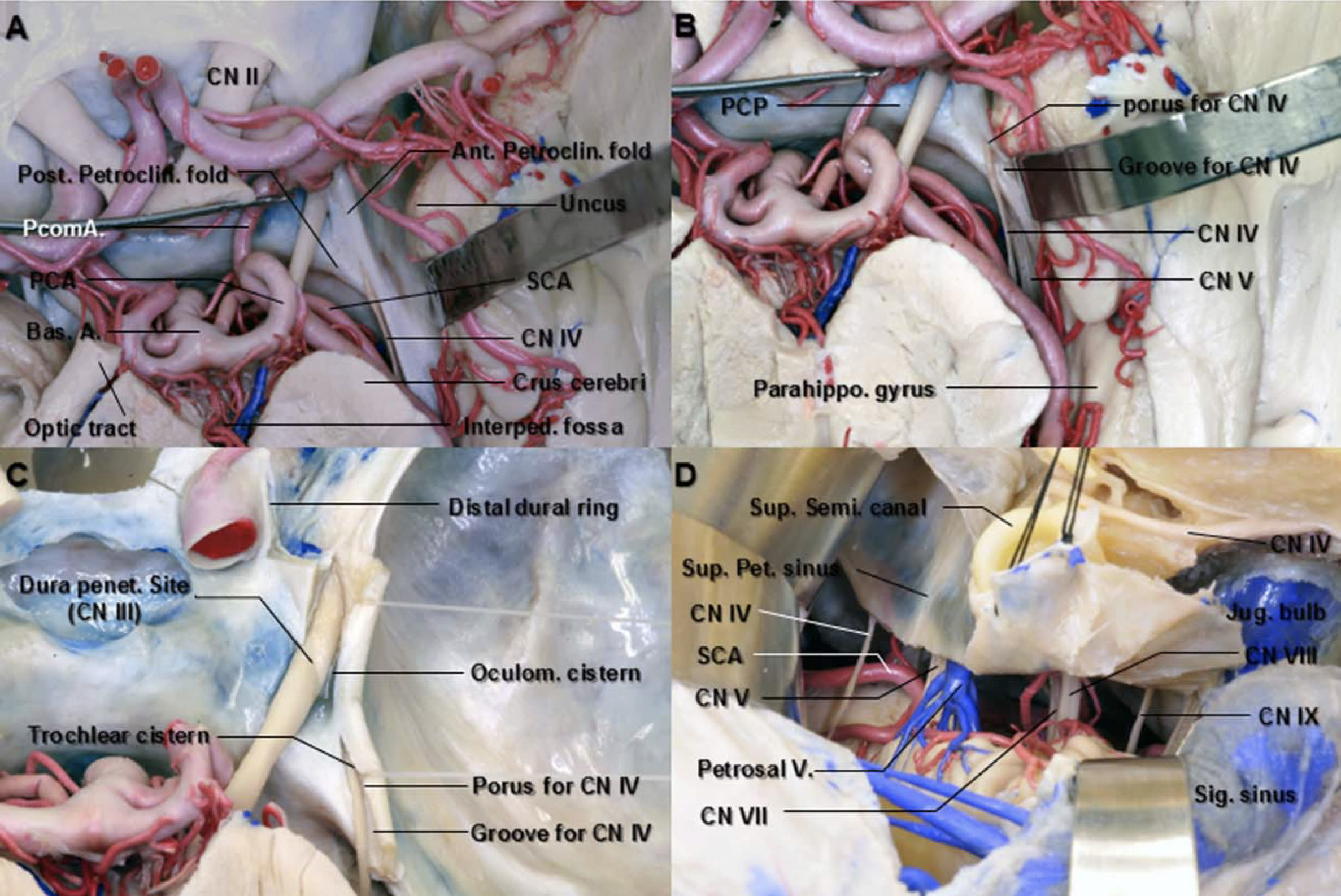 Dissection to Expose the Trochlear Nerve | Neuroanatomy | The ...