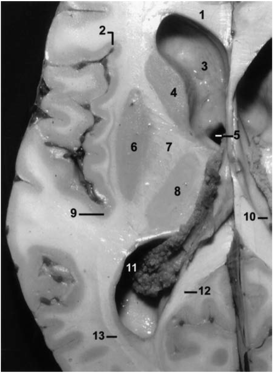 Central Core of the Left Hemisphere | Neuroanatomy | The Neurosurgical ...